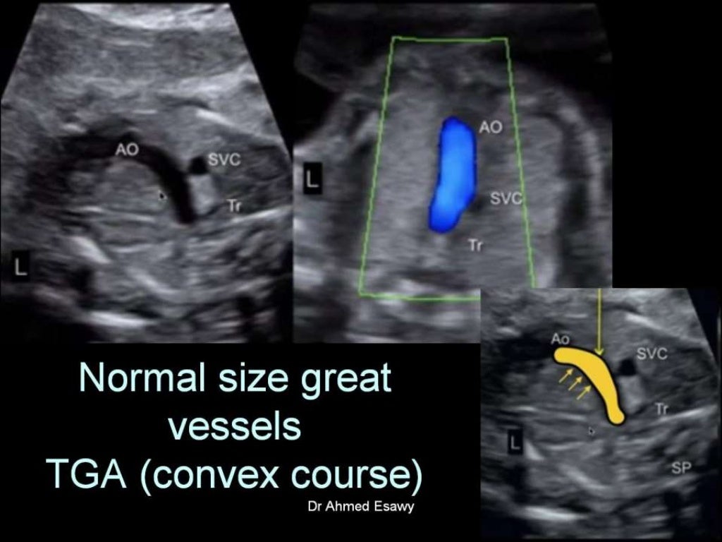 Fetal echo three vessel trachea view 3 vt dr ahmed esawy