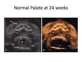 Cleft Palate Ultrasound