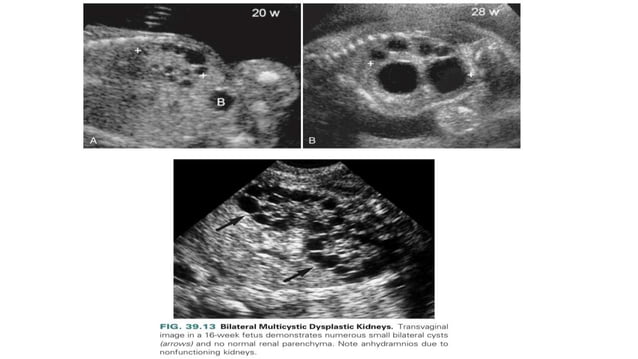 Radiology of Fetal genitourinary tract.pptx | Pregnancy | Reproductive ...