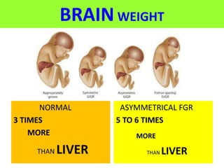 FETAL GROWTH RETARDATION In Modern Practice –Made Simple | PPTX