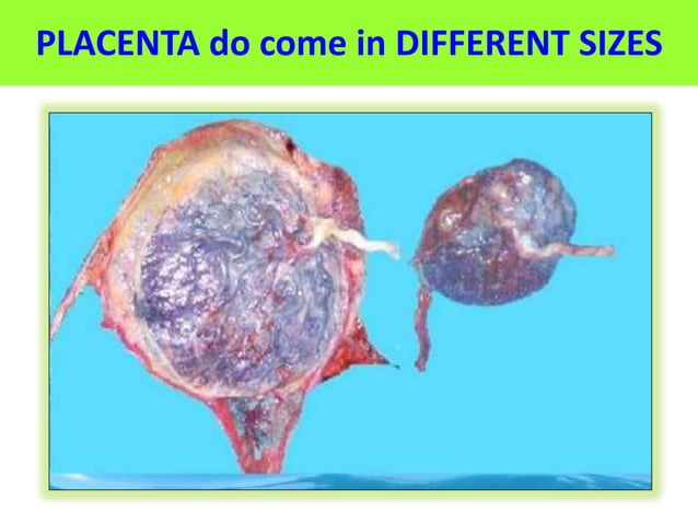 FETAL GROWTH RETARDATION In Modern Practice –Made Simple | PPTX ...