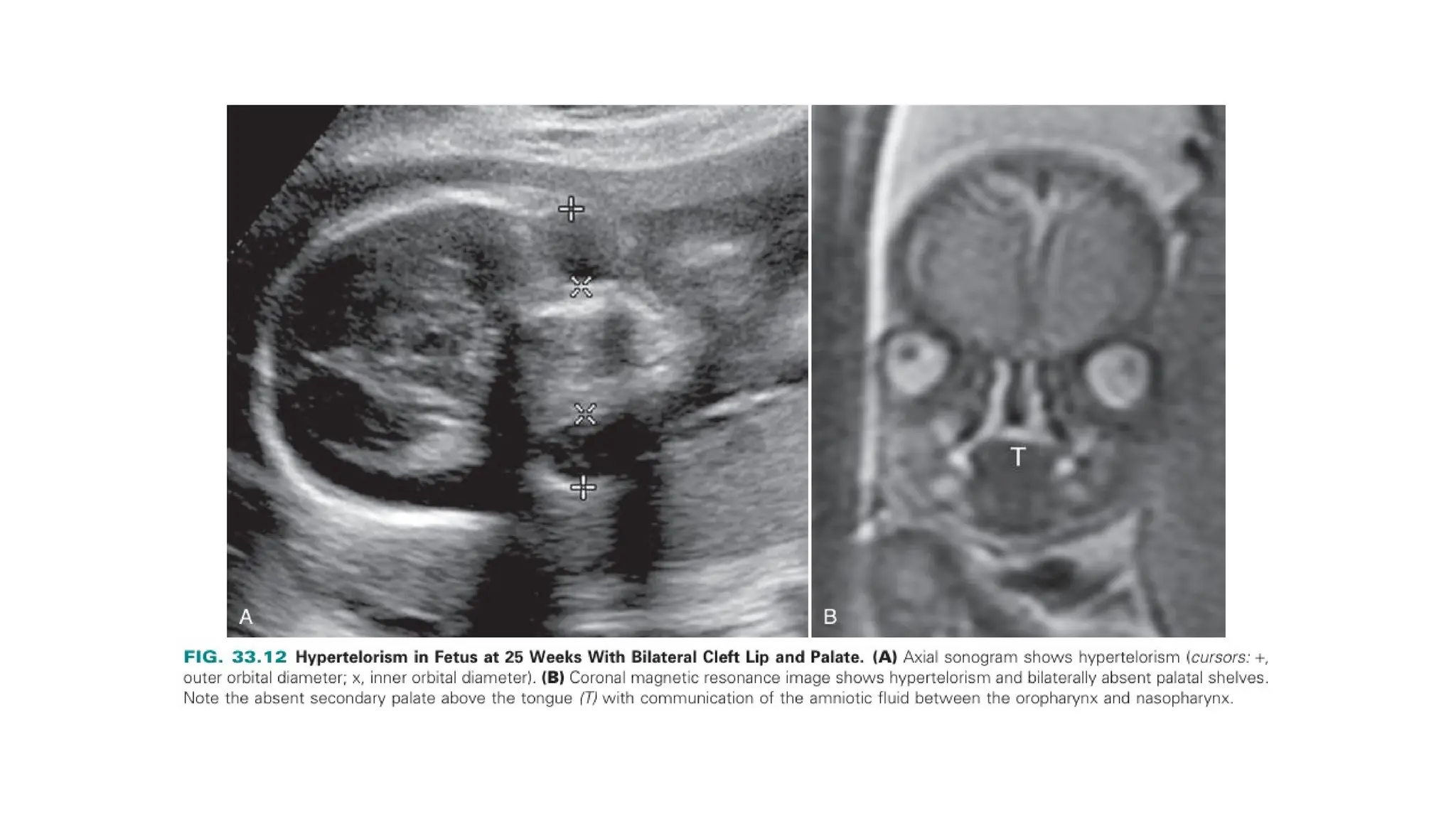 fetal head and neck imaging and spotters | PPTX