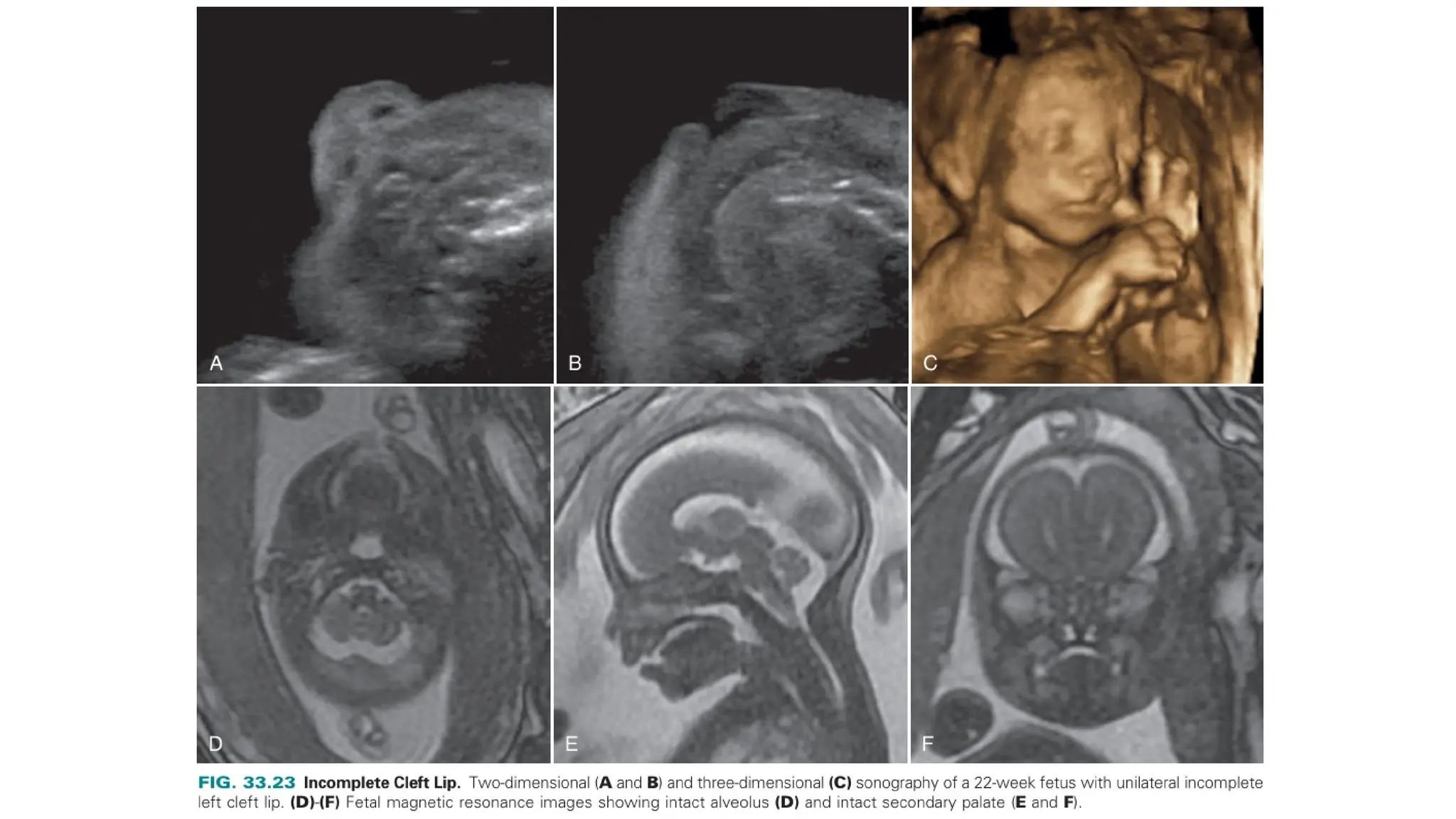 fetal head and neck imaging and spotters | PPTX