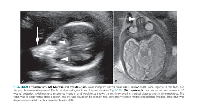 fetal head and neck imaging and spotters | PPTX | Pregnancy ...