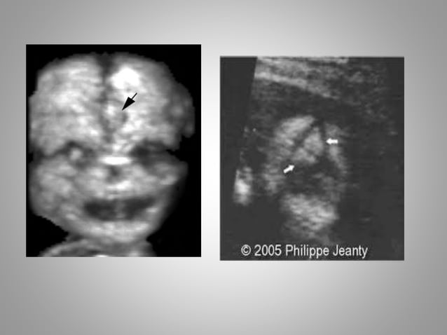 Fetal head & neck usg | PPTX | Pregnancy | Reproductive Health