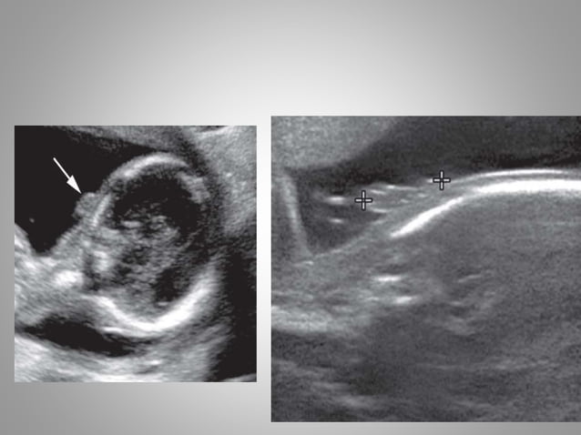 Fetal head & neck usg | PPTX | Pregnancy | Reproductive Health