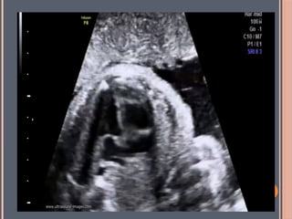 Congenital anomalies mixed appearance of fetal heart and chest.pptx