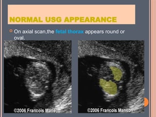 Congenital anomalies mixed appearance of fetal heart and chest.pptx