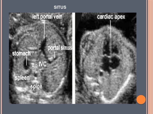 Congenital anomalies mixed appearance of fetal heart and chest.pptx
