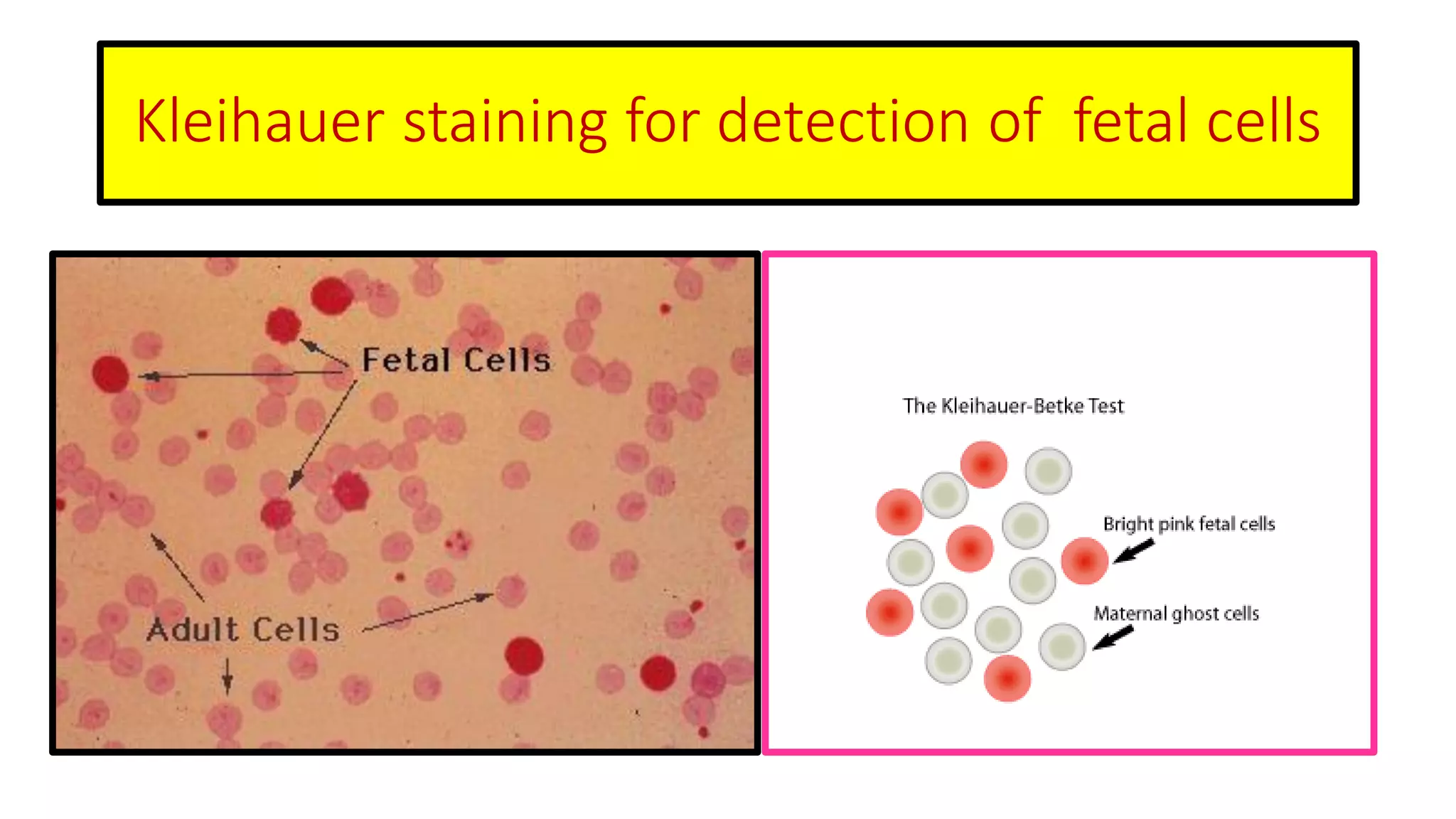 Fetal hemoglobin and rh incompatibility | PDF
