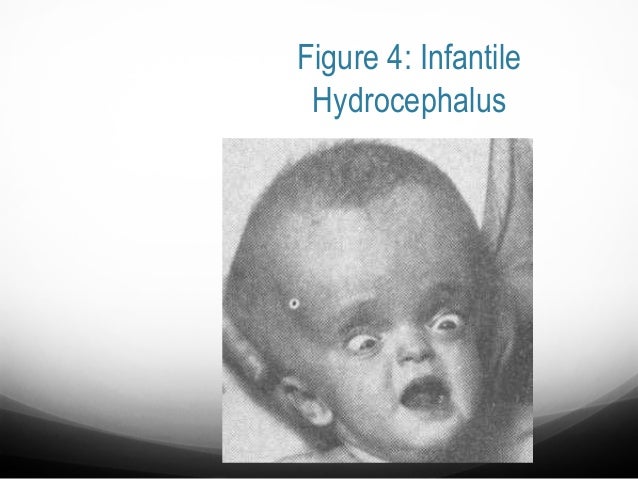 Fetal, infant and pediatric hydrocephalus medical report