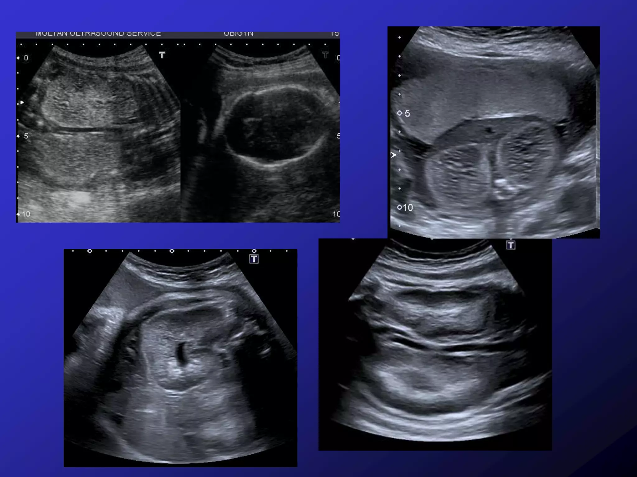 Antenatal diagnosis of Congenital Anomalies of Kidneys and Urinary ...