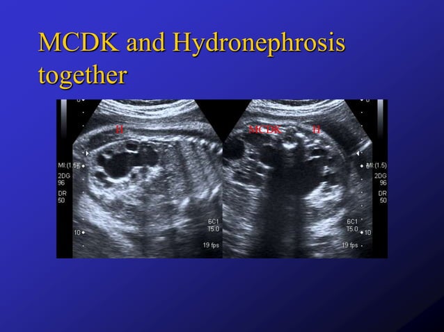 Antenatal diagnosis of Congenital Anomalies of Kidneys and Urinary ...