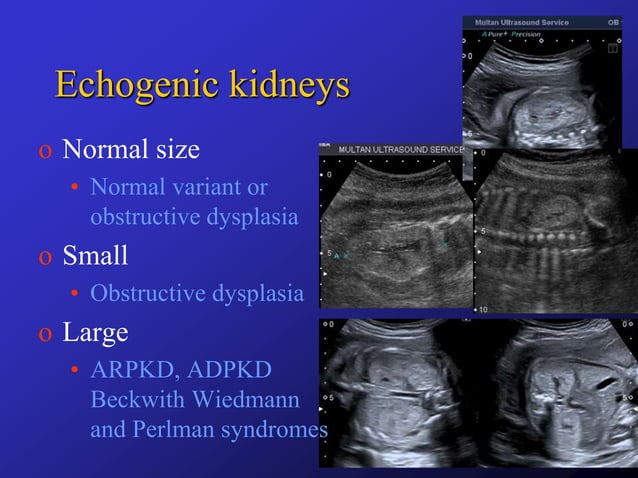 Antenatal diagnosis of Congenital Anomalies of Kidneys and Urinary ...