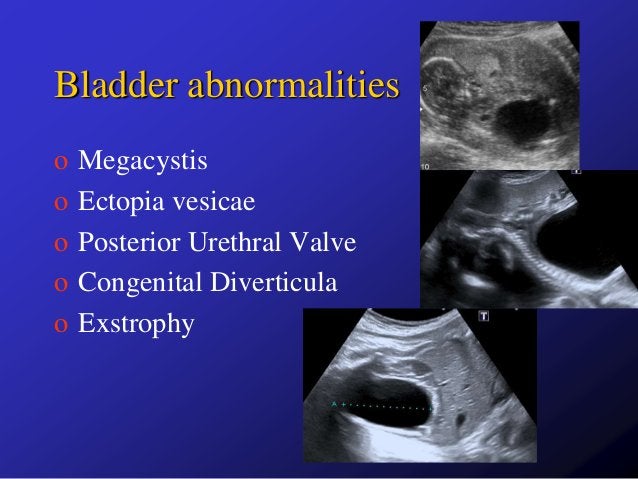 Antenatal diagnosis of Congenital Anomalies of Kidneys and Urinary ...