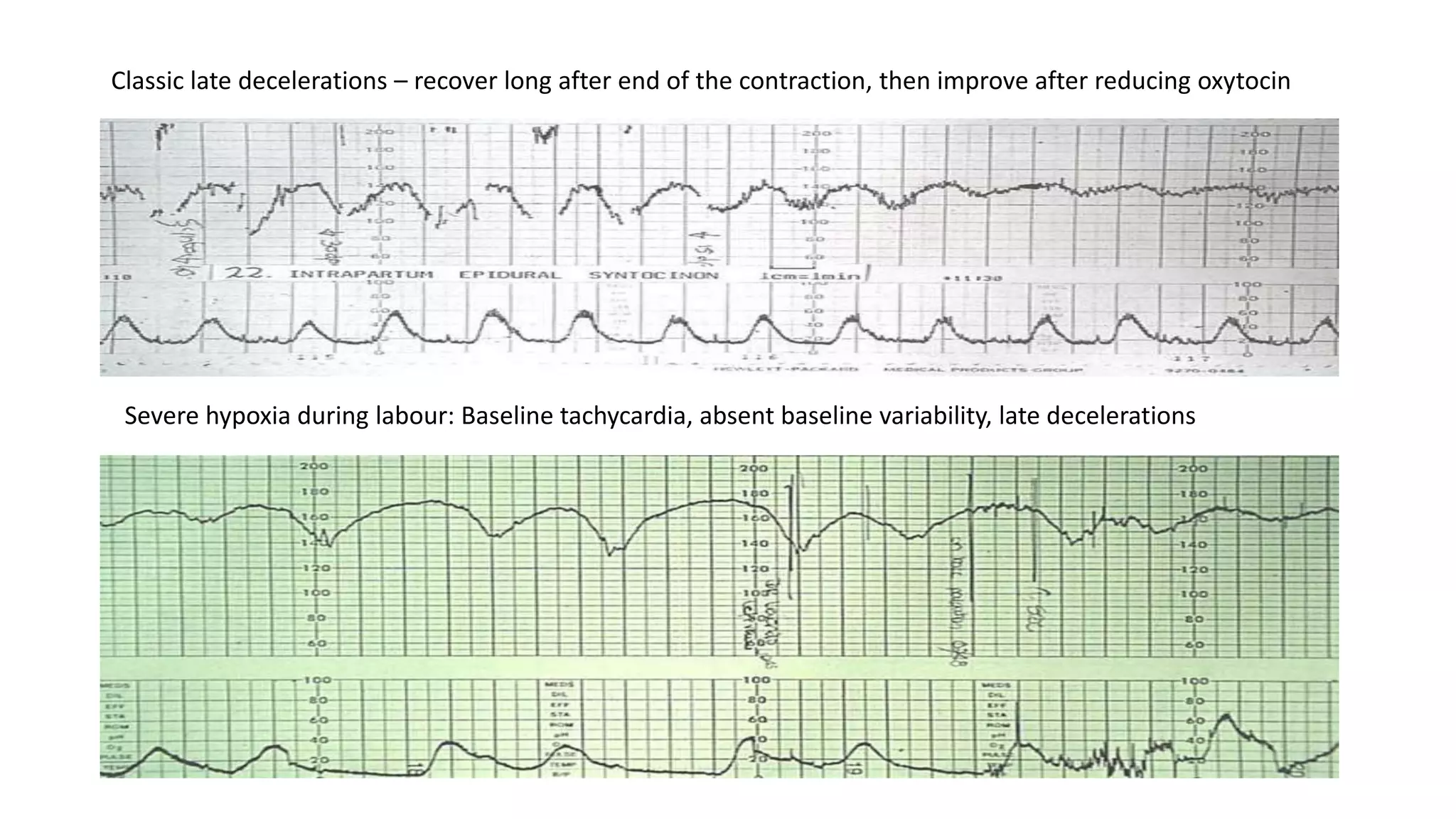 Fetal monitoring.pptx