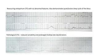 Fetal monitoring.pptx