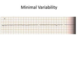 Fetal_Monitoring.pptx
