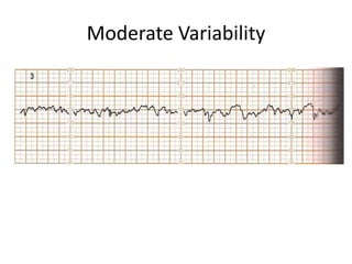 Fetal_Monitoring.pptx