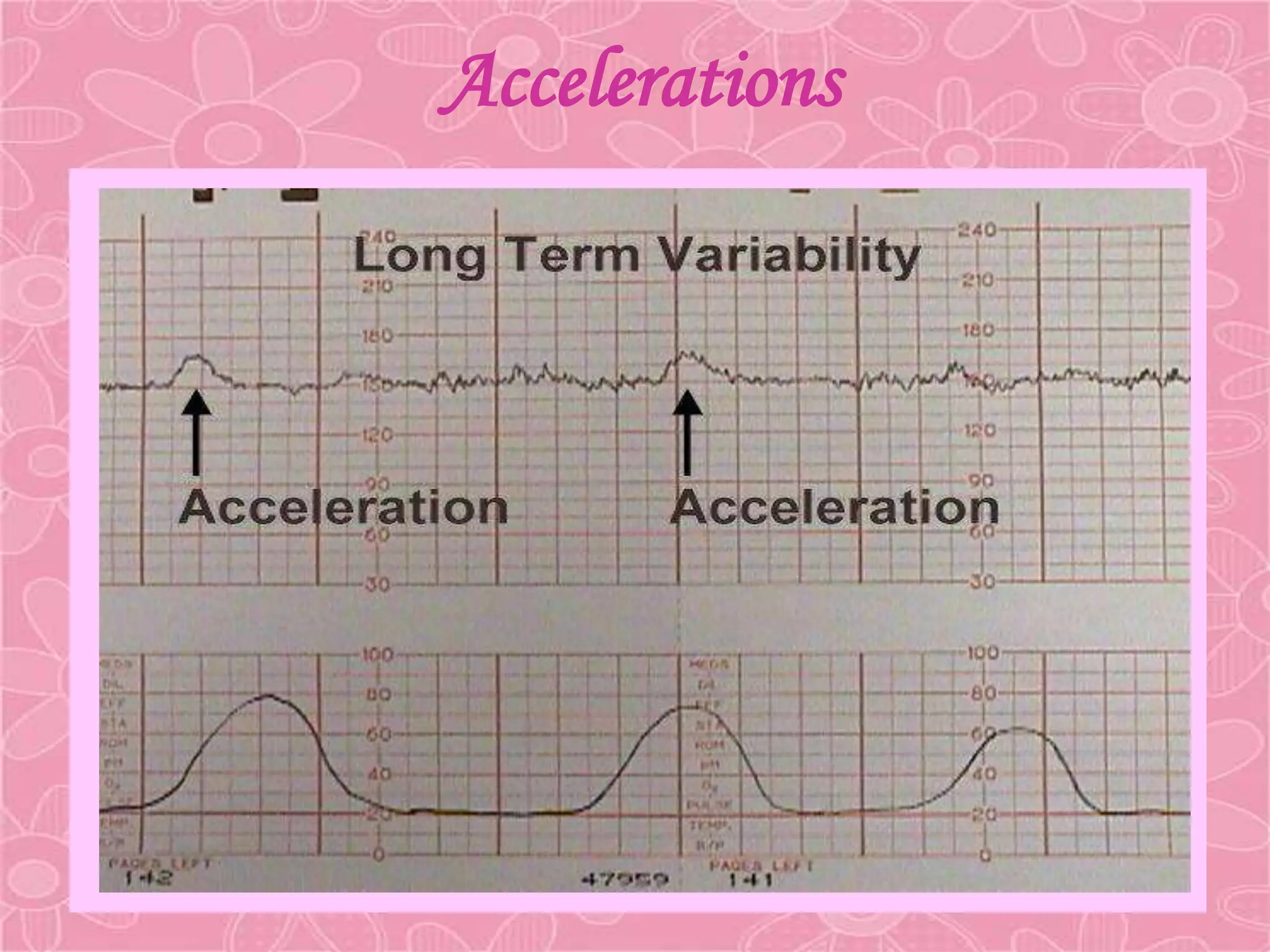 fetal monitoring (2).ppt