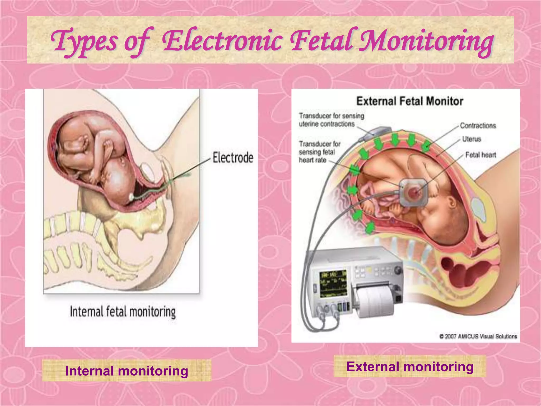 fetal monitoring (2).ppt