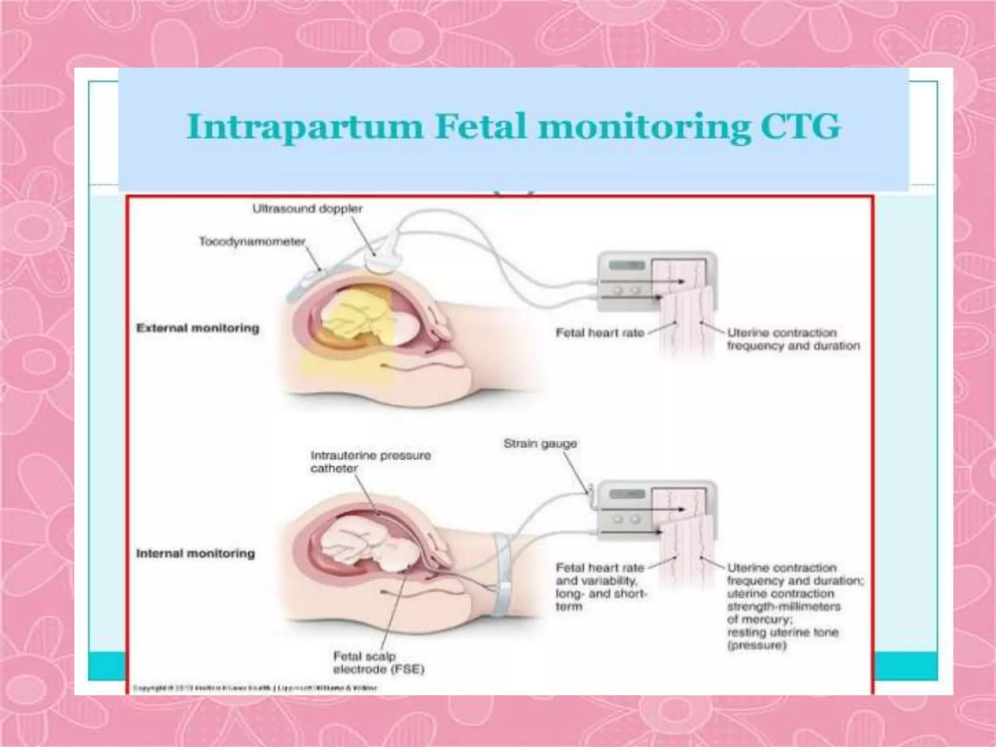 fetal monitoring (2).ppt