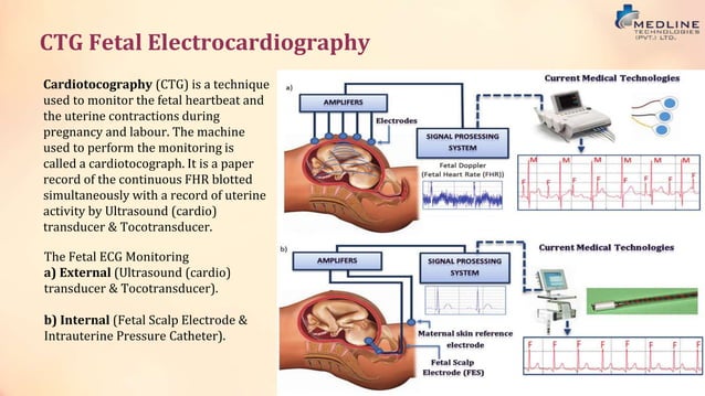 Fetal Monitoring Devices | PPTX | Pregnancy | Reproductive Health