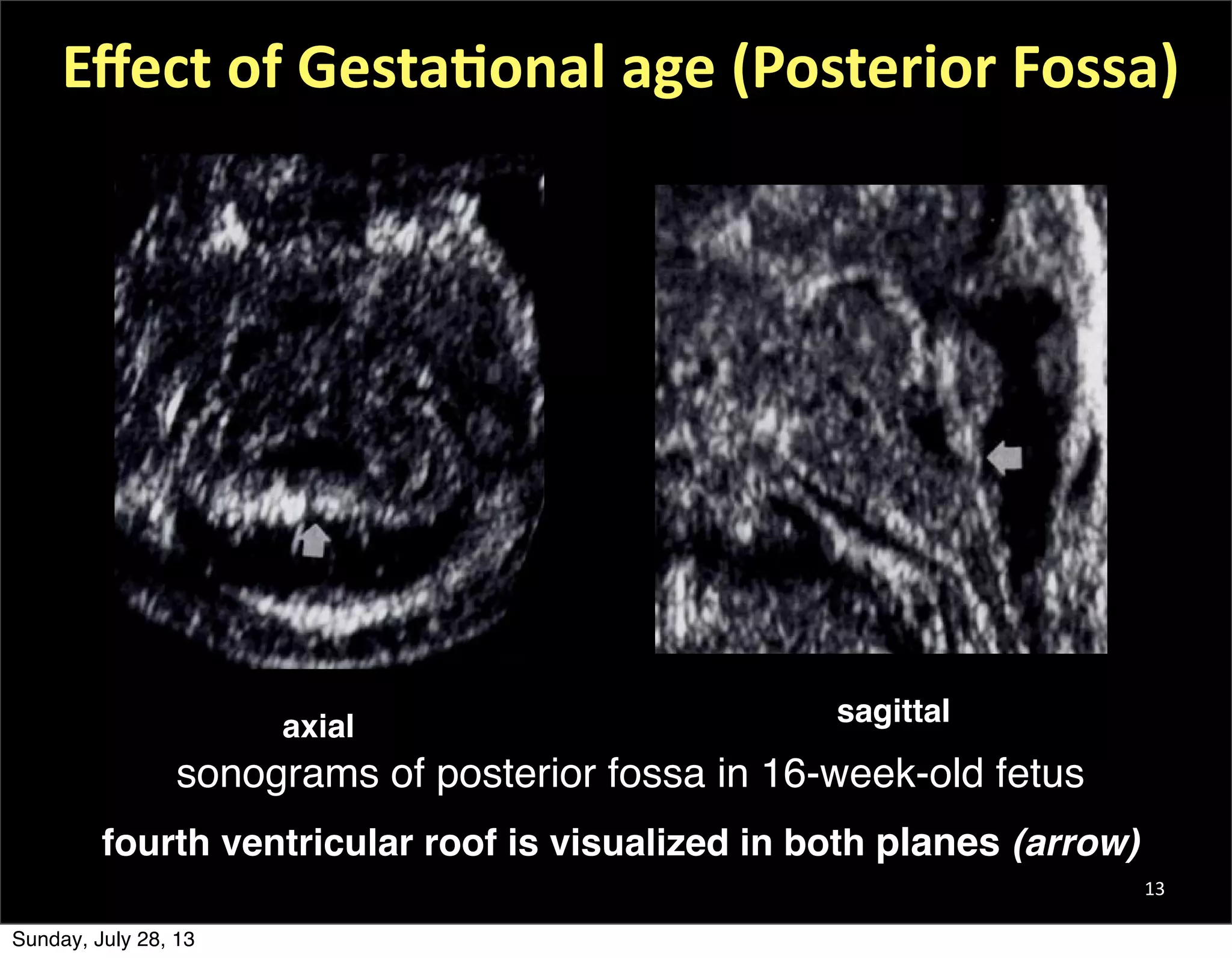 Fetal neurosonogram jucog feb 2013 | PDF