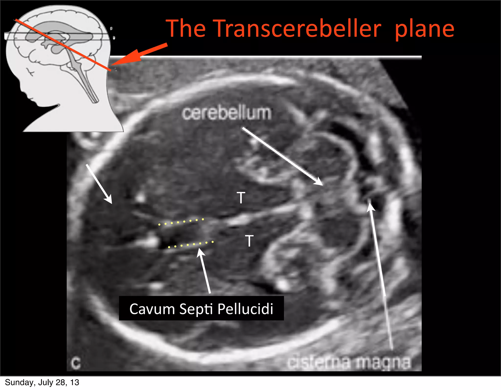 Fetal neurosonogram jucog feb 2013 | PDF | Pregnancy | Reproductive Health