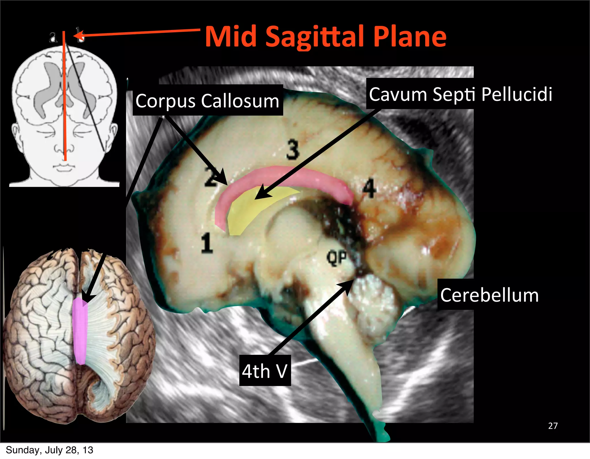 Fetal neurosonogram jucog feb 2013 | PPT