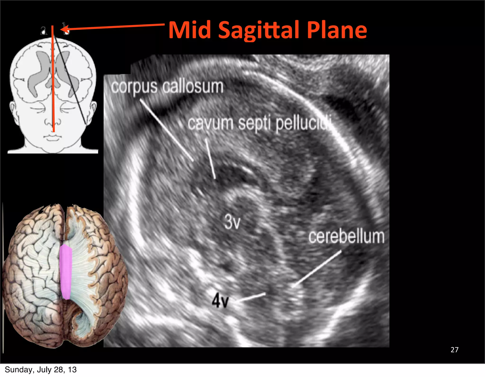 Fetal neurosonogram jucog feb 2013 | PDF | Pregnancy | Reproductive Health