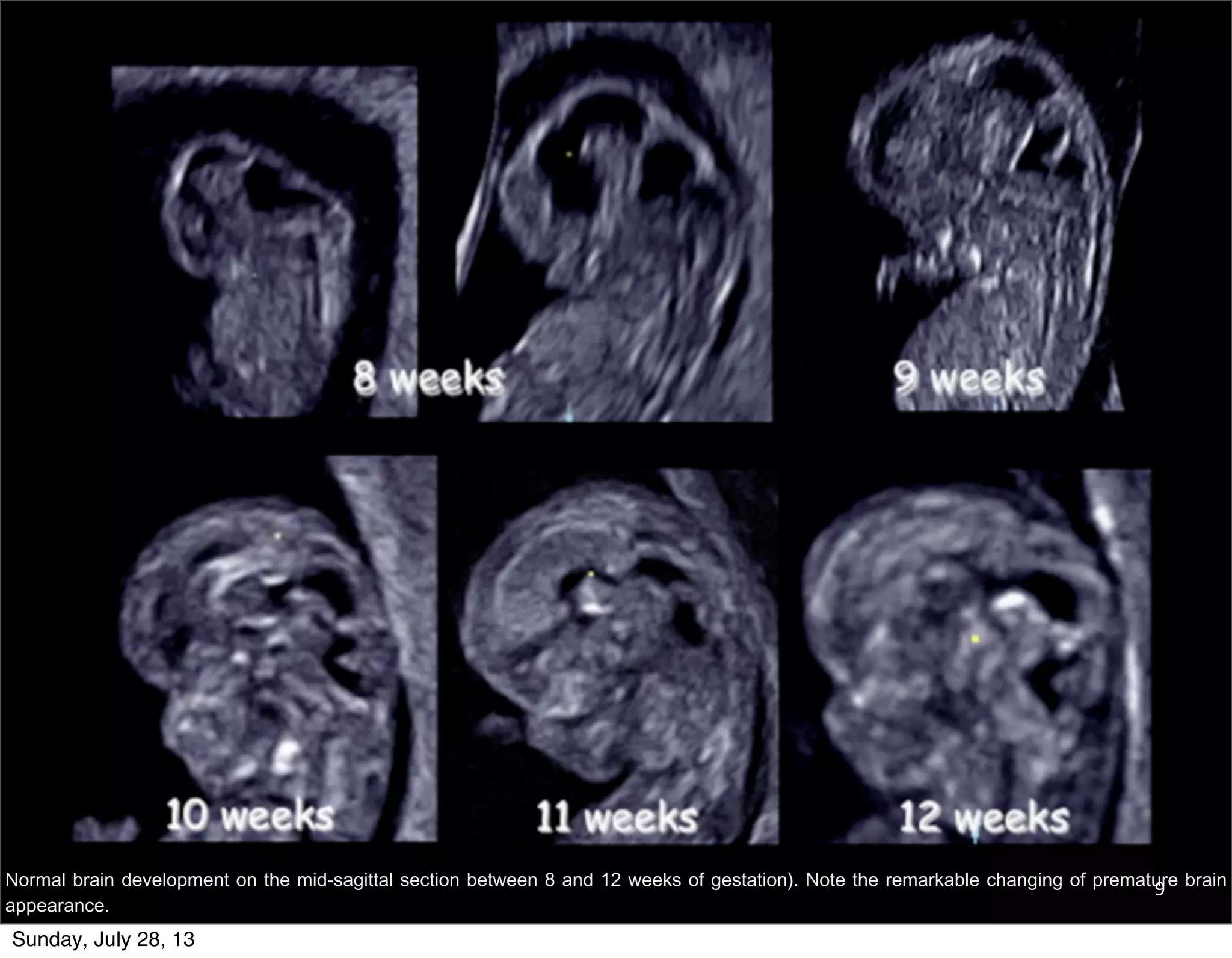 Fetal Neurosonogram | PDF