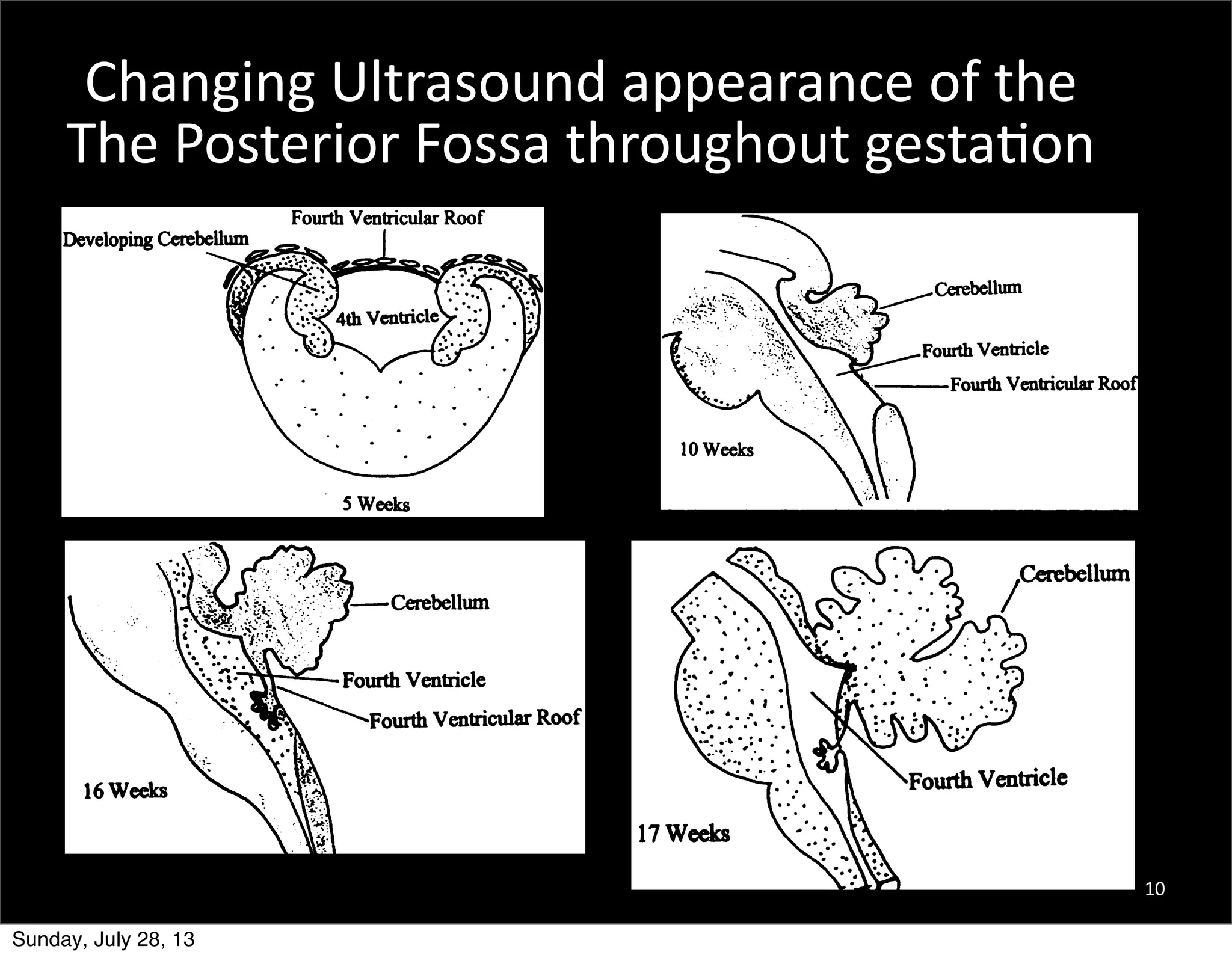 Fetal Neurosonogram | PDF