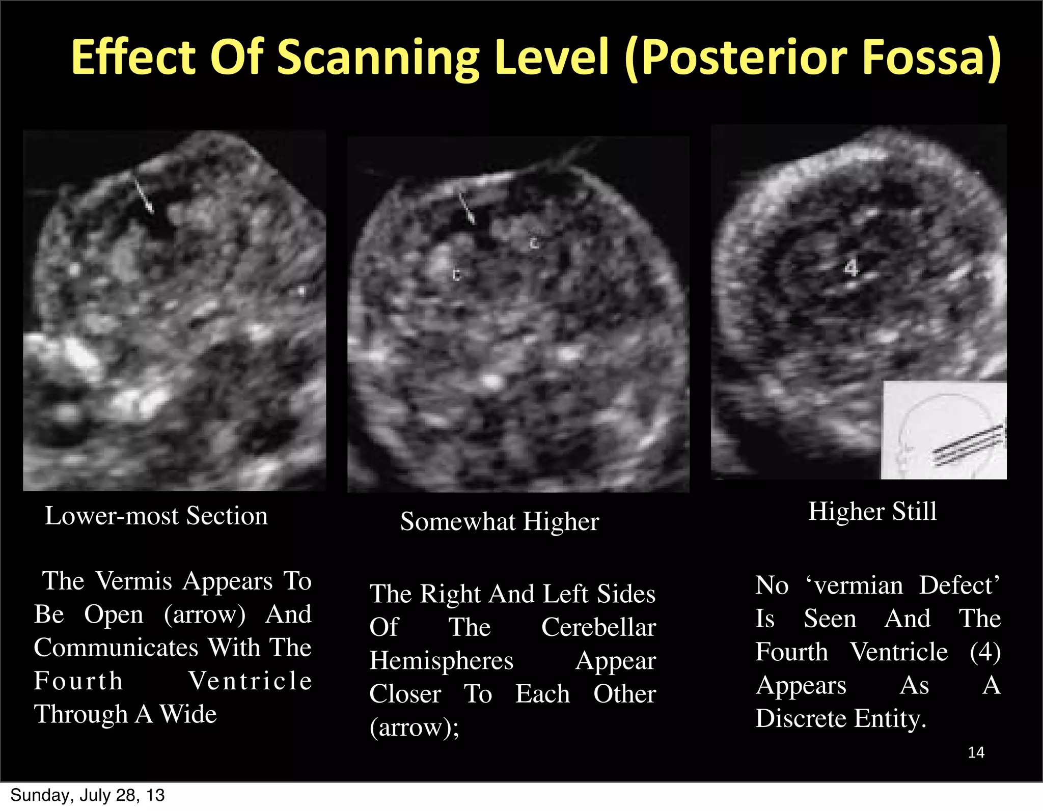 Fetal Neurosonogram | PDF