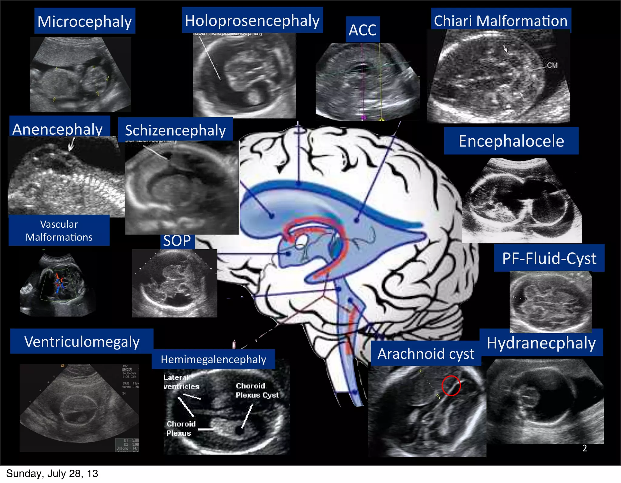 Fetal Neurosonogram | PDF