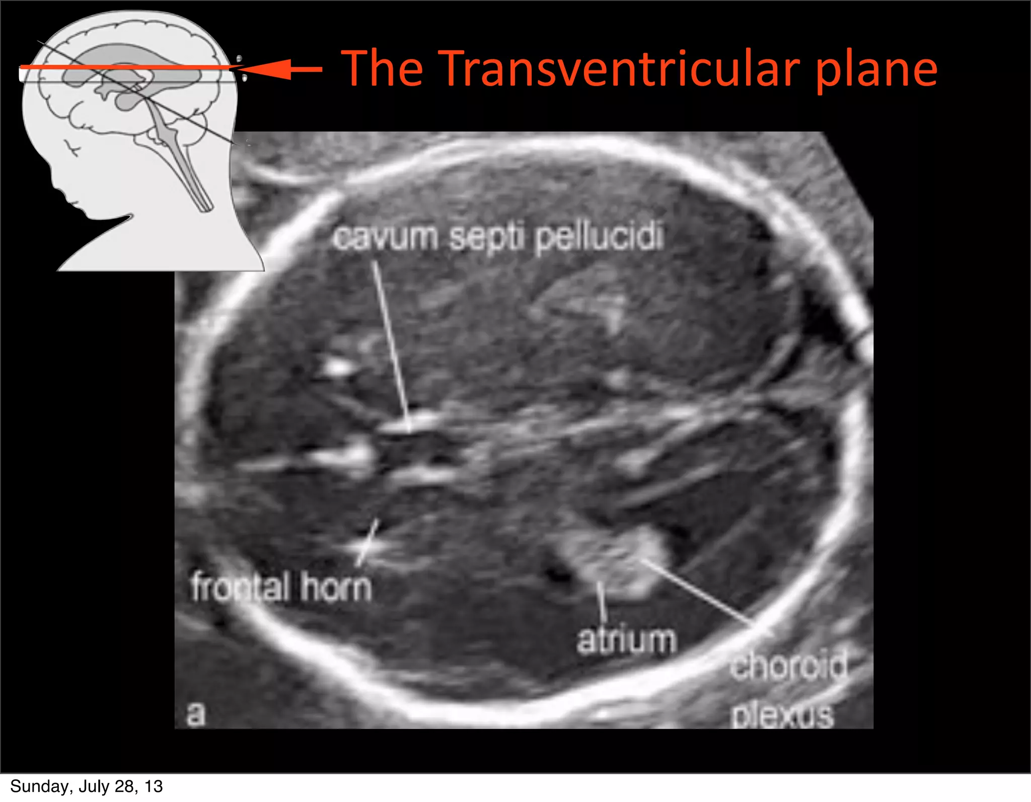 Fetal Neurosonogram | PDF