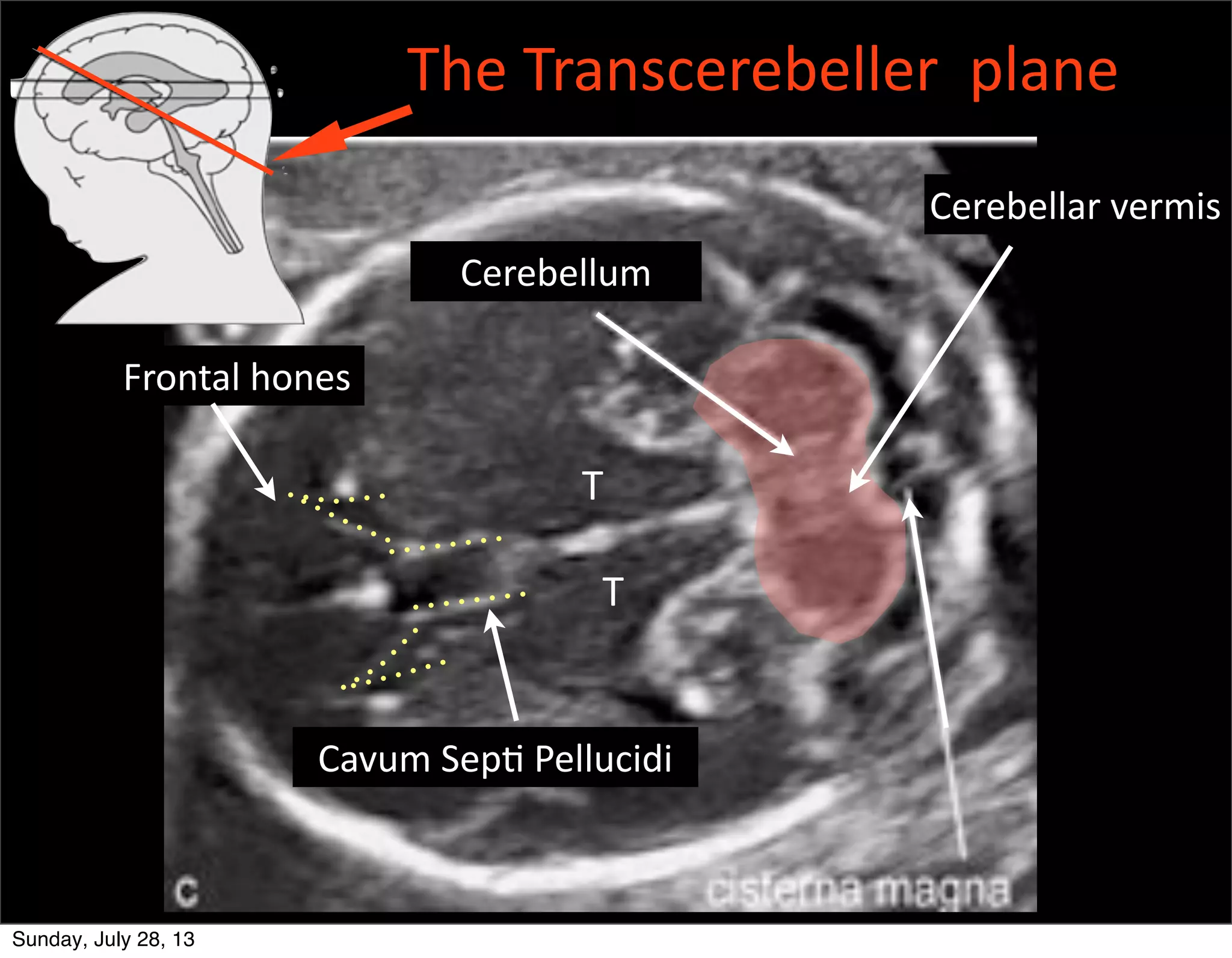 Fetal Neurosonogram | PDF