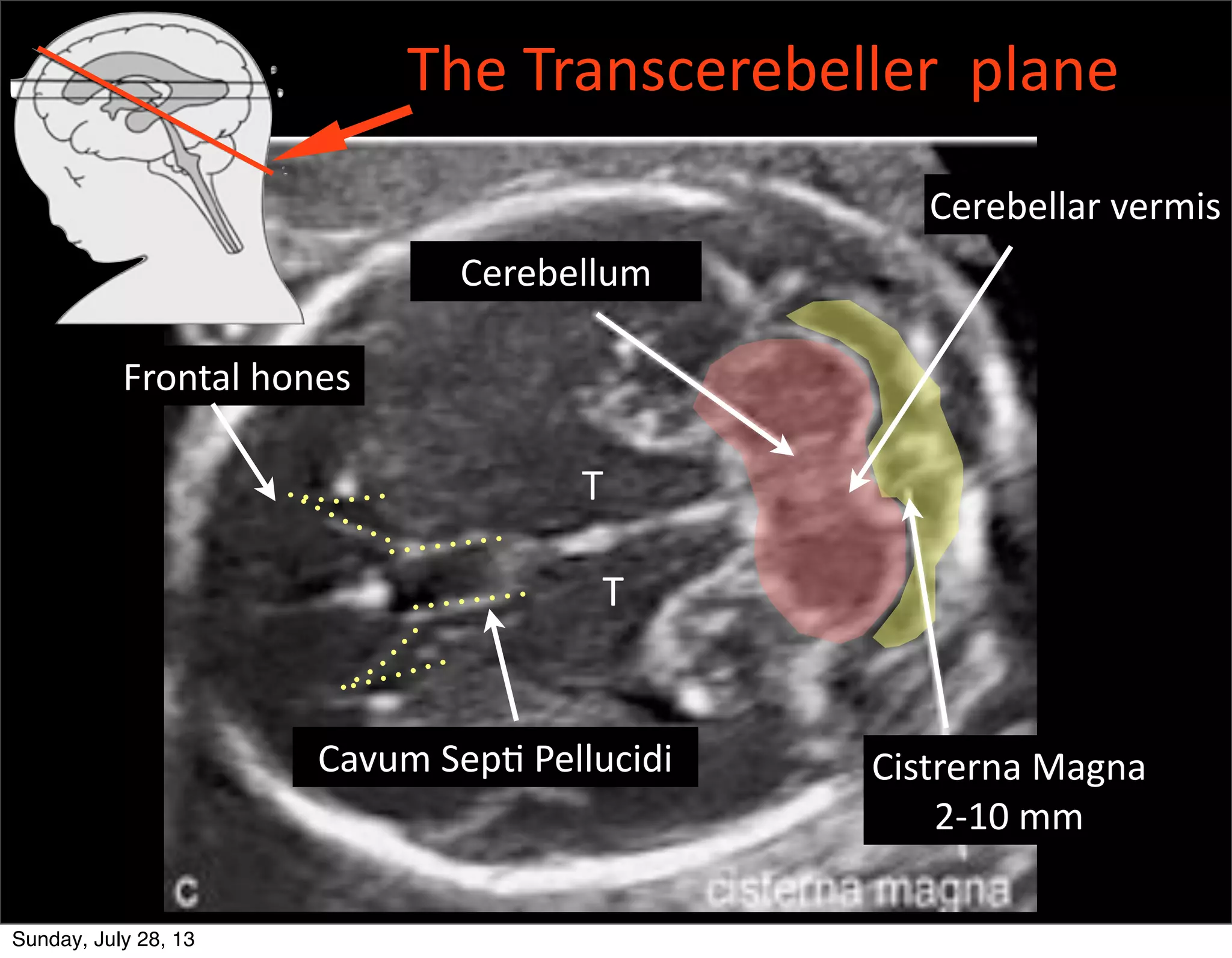 Fetal Neurosonogram | PDF