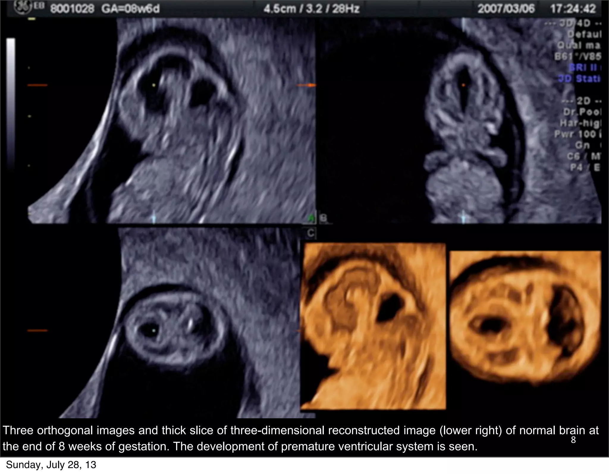 Fetal Neurosonogram | PDF