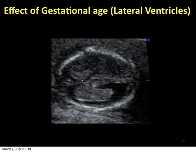 Fetal Neurosonogram | PDF