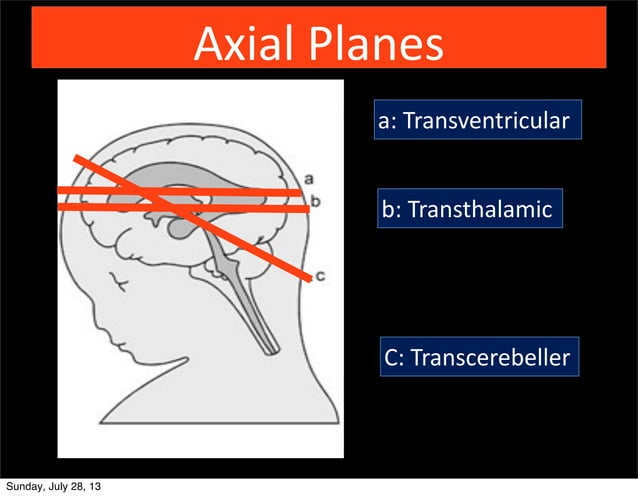 Fetal Neurosonogram | PDF