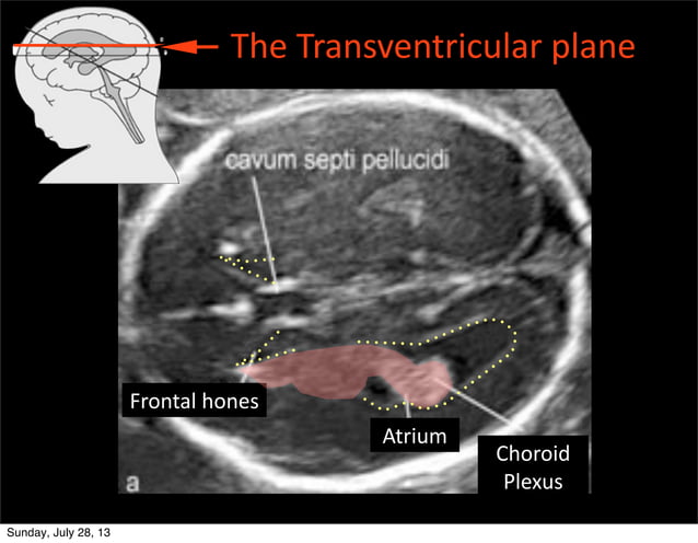 Fetal Neurosonogram | PDF