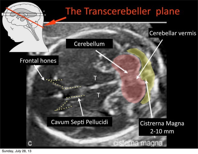 Fetal Neurosonogram | PDF