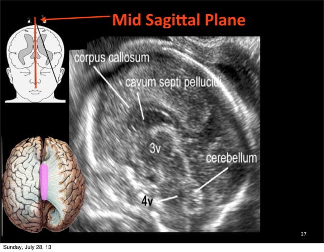 Fetal Neurosonogram | PDF