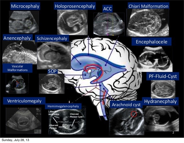Fetal Neurosonogram