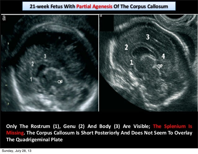 Fetal Neurosonogram