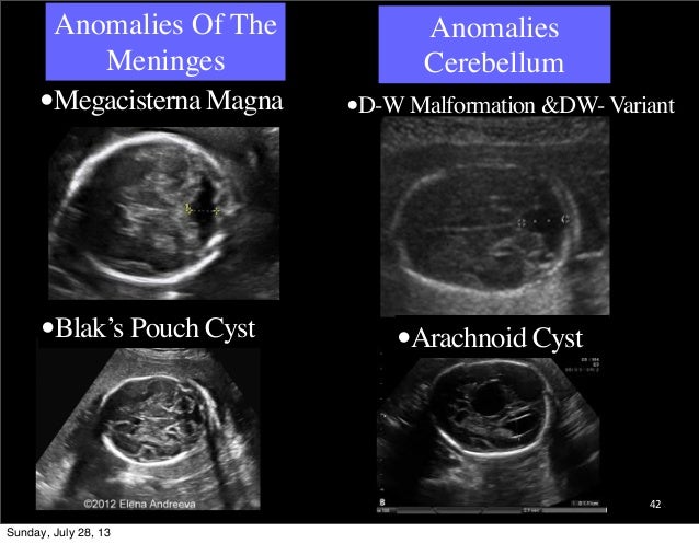 Fetal Neurosonogram