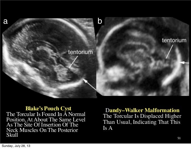 Fetal Neurosonogram