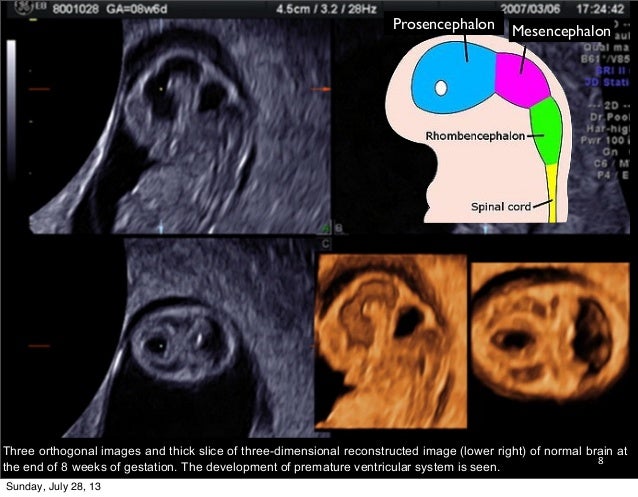 Fetal Neurosonogram