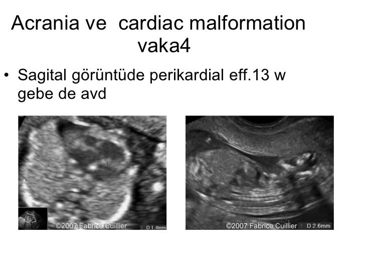Fetal nörosonografi